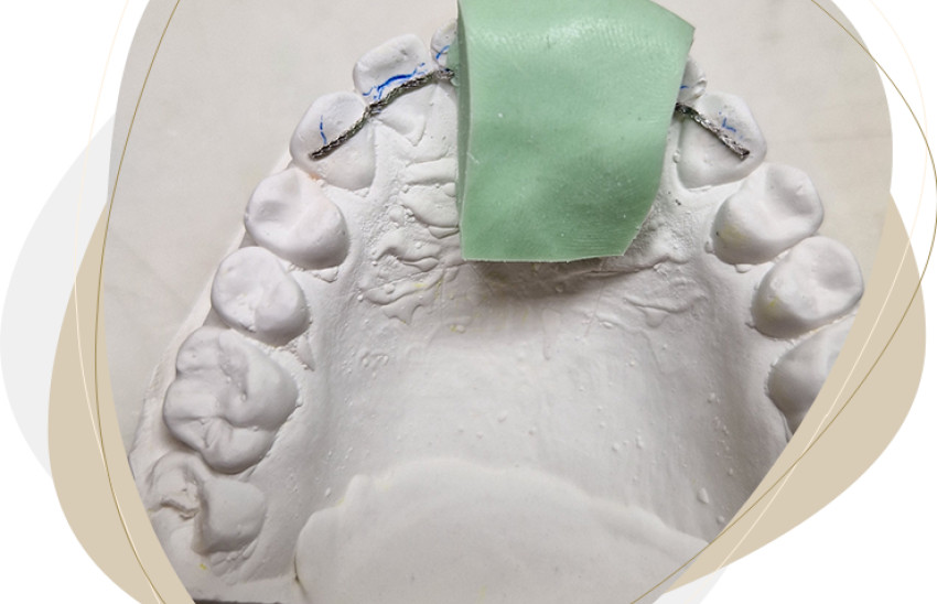 Permanent retainer with transfer - Kardent - Producent aparatów ...